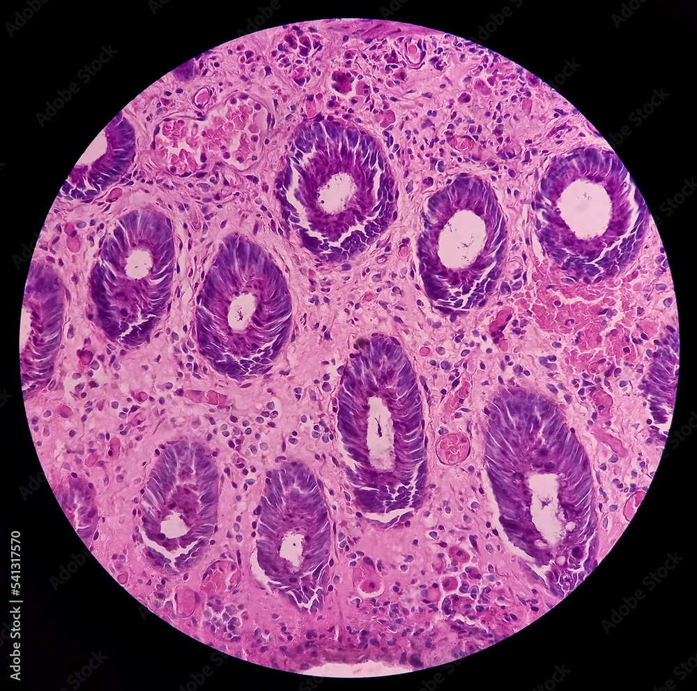 Anal canal ulcer biopsy: Chronic nonspecific proctitis, show anal ...
