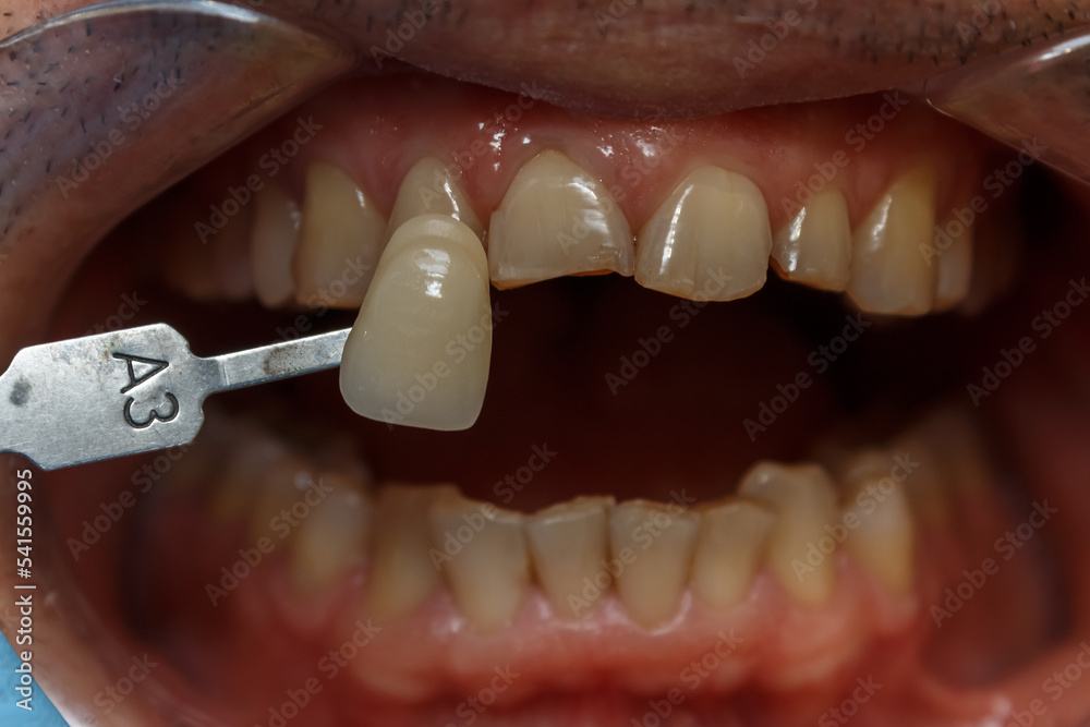 Determination of tooth color using a sample. Preparation for prosthetic ...
