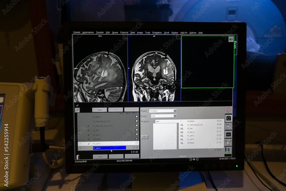 Step by step Visualase is an MRI-guided laser ablation system used to ...