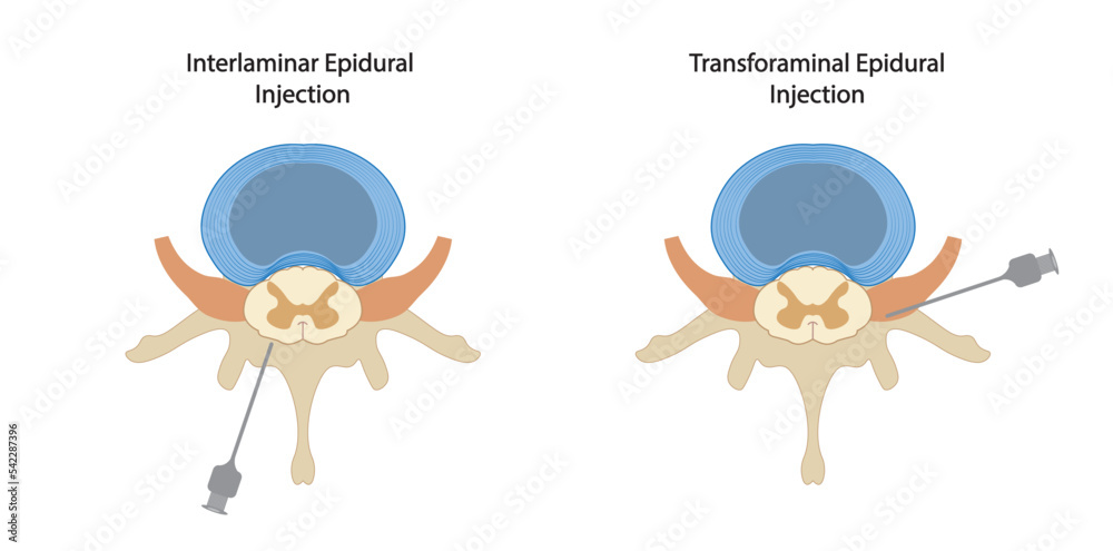 Epidural injection. Illustration of two differents techniques of ...