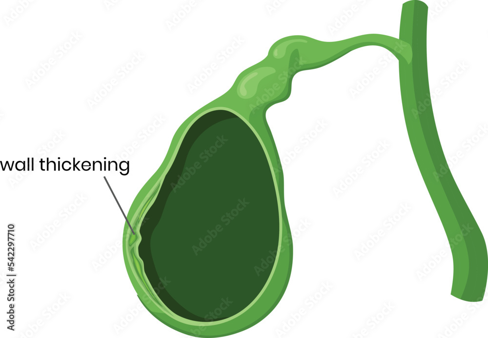 Illustration of the gallbladder wall thickening. Vector immage of the ...