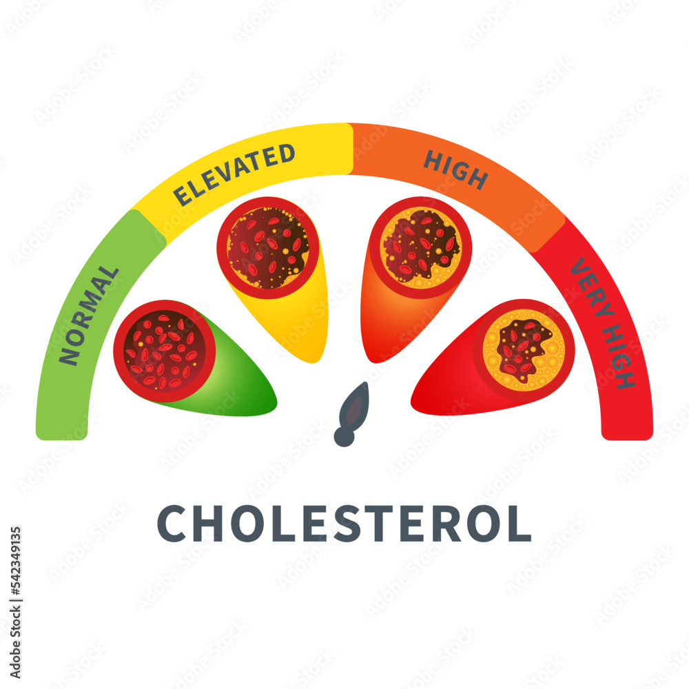 Different stages of cholesterol plaque buildup in artery. Low to high ...
