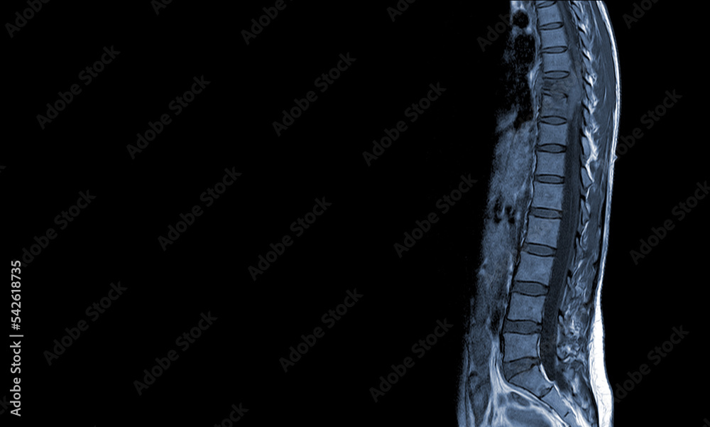 MRI of thoracic spine Moderate pathologic compression fracture of T9 ...