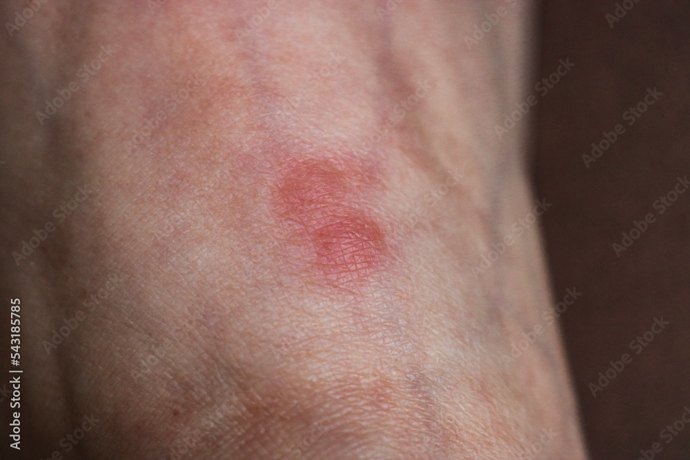 Red inflammation from damage to human skin after an insect bite. An ant ...