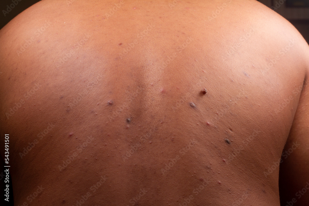 Foto de Stock human skin texture. wart and pimples on skin micro photo ...