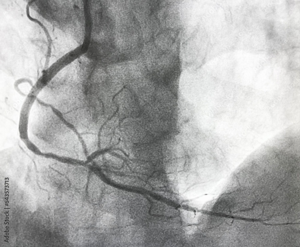 Coronary angiogram (CAG) shown right coronary artery. Stock Photo ...