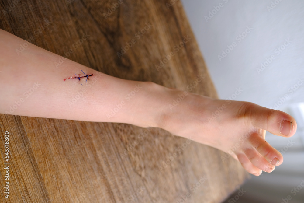 fresh wound on child's leg, non-absorbable sutures, wound care after ...