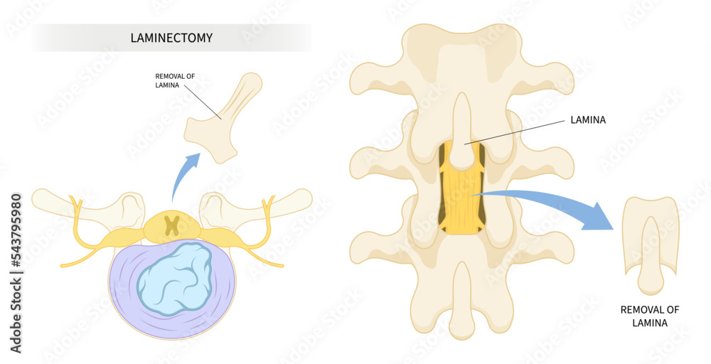Стоковое векторное изображение «compressed back nerve lumbar of annular ...