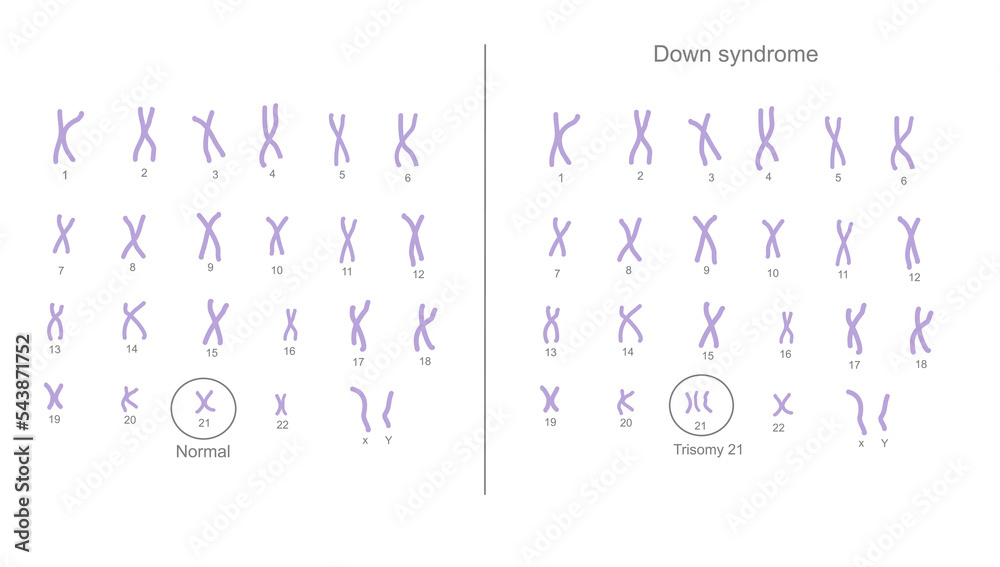 The chromosome 21 are changed the copy number from normal (2 copies) to ...