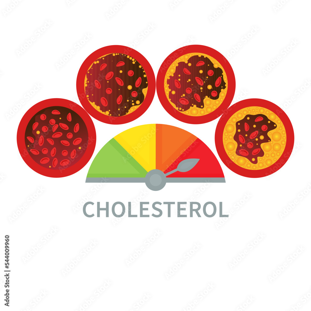 Cholesterol plaque buildup level on blood vessel medical diagram. Meter ...