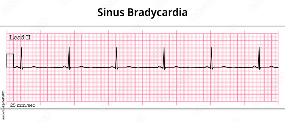 ECG Sinus Bradycardia - 8 Second ECG Paper Stock Vector | Adobe Stock