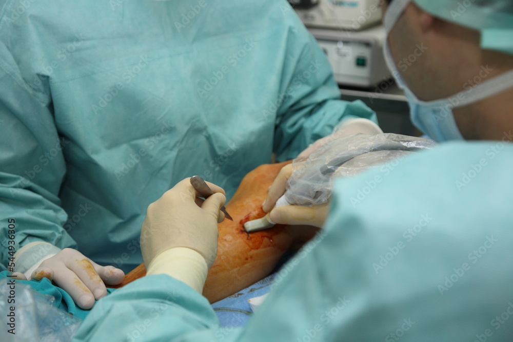 Foto de Stock Preparing the patient for phlebectomy surgery. Surgical ...