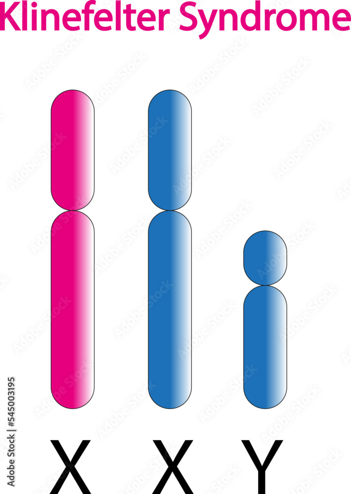Scientific conception of Klinefelter syndrome (XXY). Colorful symbols ...