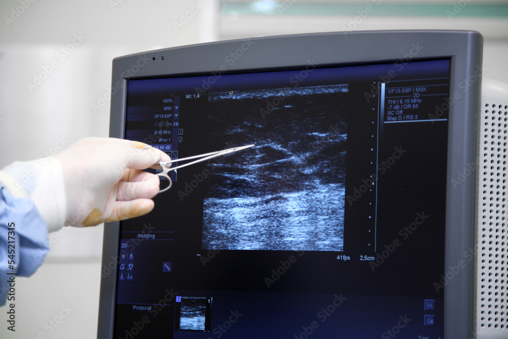 Varicose veins and varicose treatment image reflected on the screen ...