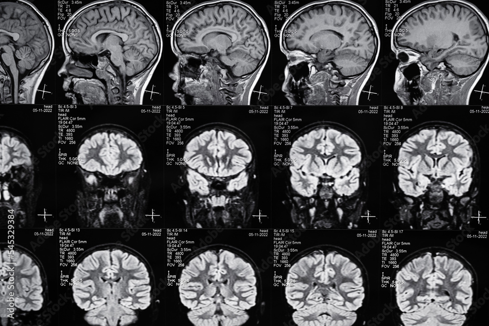 Foto High resolution magnetic resonance image scan of brain epi ...