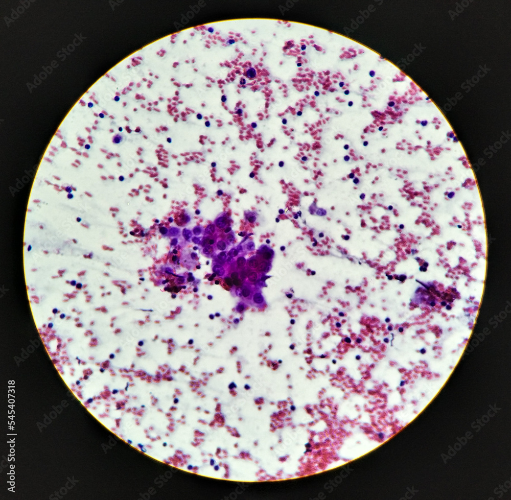 Intra abdominal mass(Cytology): Spindle cell sarcoma, positive ...