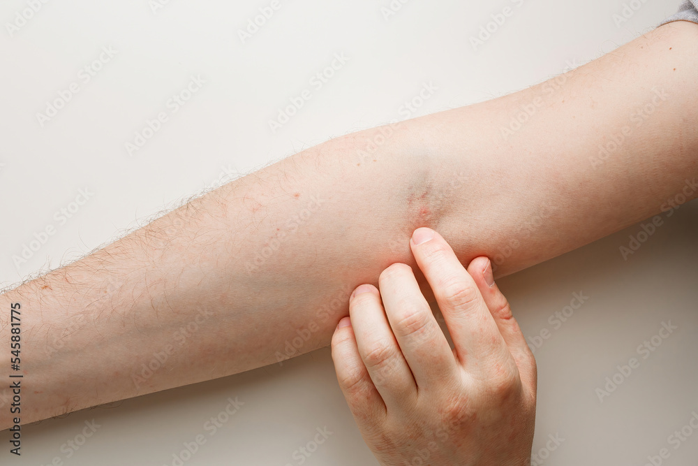 Forefinger points on vein injection mark on arm. Bruising, redness from ...