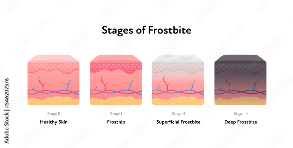 Frostbite anatomical infographic poster. Vector flat medical ...