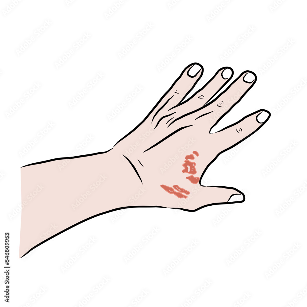 hand skin lesions isolated on white background Stock Vector | Adobe Stock