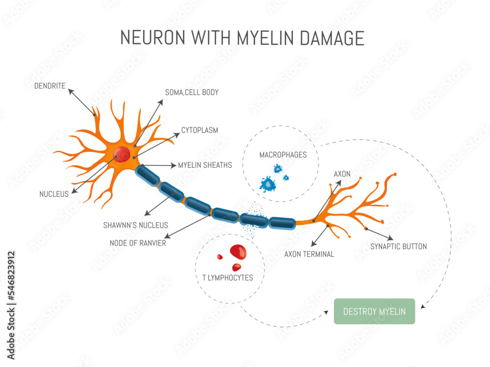 Infographic of a neuron damaged by lymphocyte and macrophage attack ...