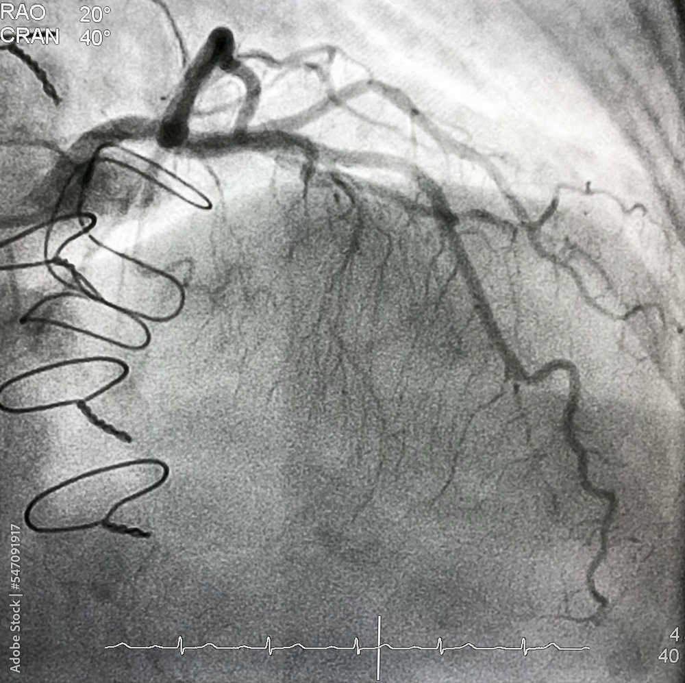 Coronary angiogram shown normal left coronary artery (LCA) with sternum ...