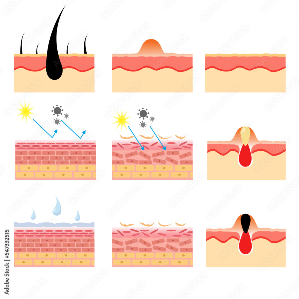 vector illustration of human skin structure anatomy. various skin ...