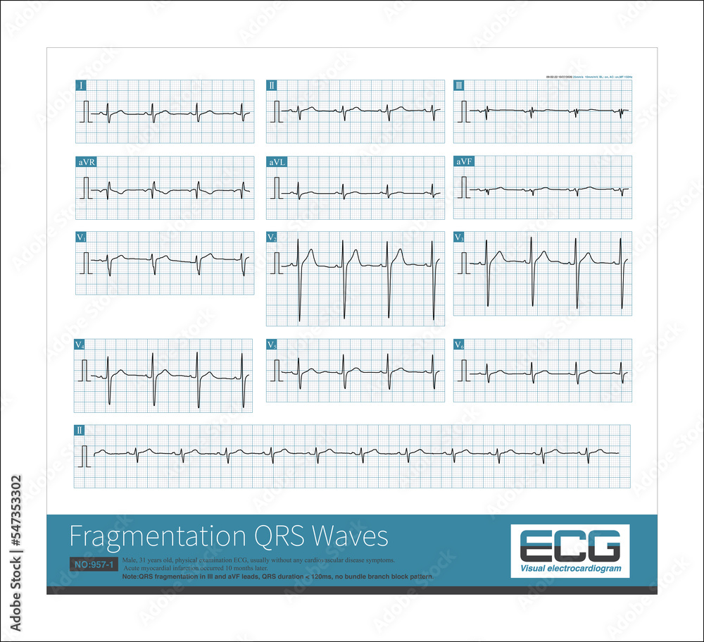 Stock-Illustration „Fragmentation QRS wave refers to the three-phase ...