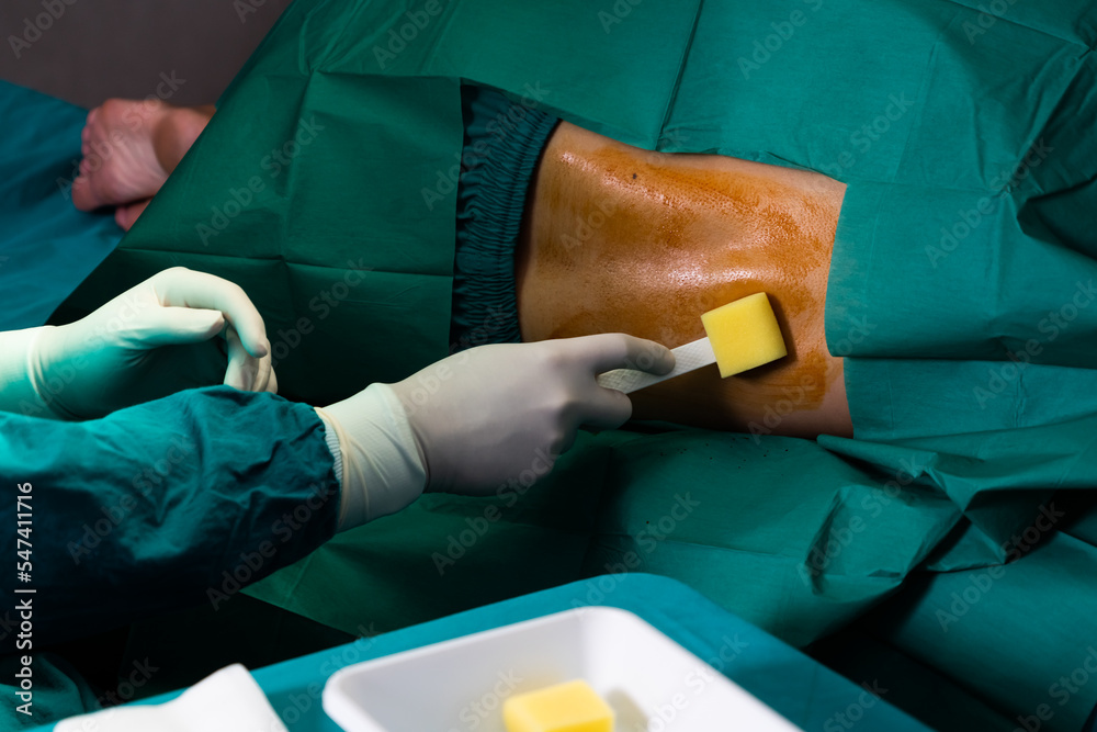 Stockfoto Doctor or surgeon apply betadine to the patient for ...