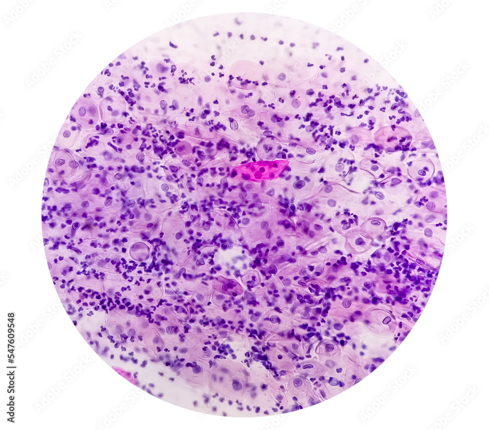 Paps smear. Microscopic examination of pap smear showing inflammatory ...