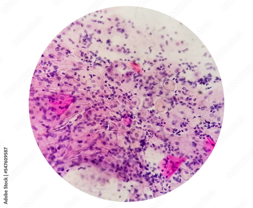 Paps smear. Microscopic examination of pap smear showing inflammatory ...