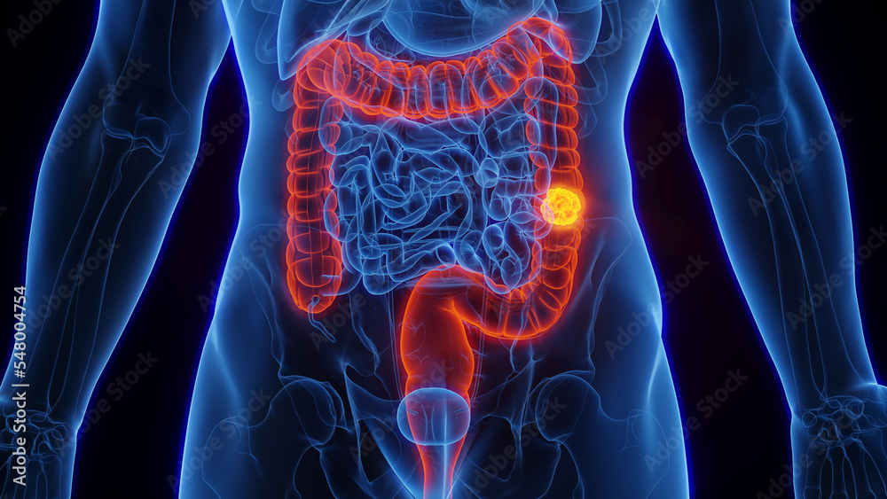 3D rendered Medical Illustration of Male Anatomy - Colon Cancer ...