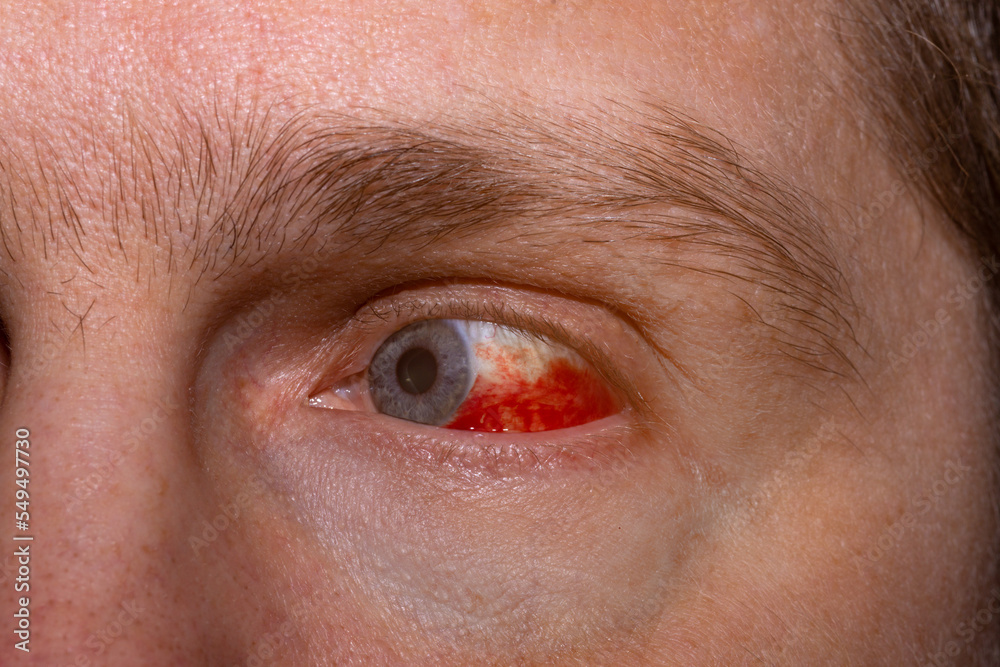 Close up of a severe bloodshot eye damage by an injury. Blepharitis ...