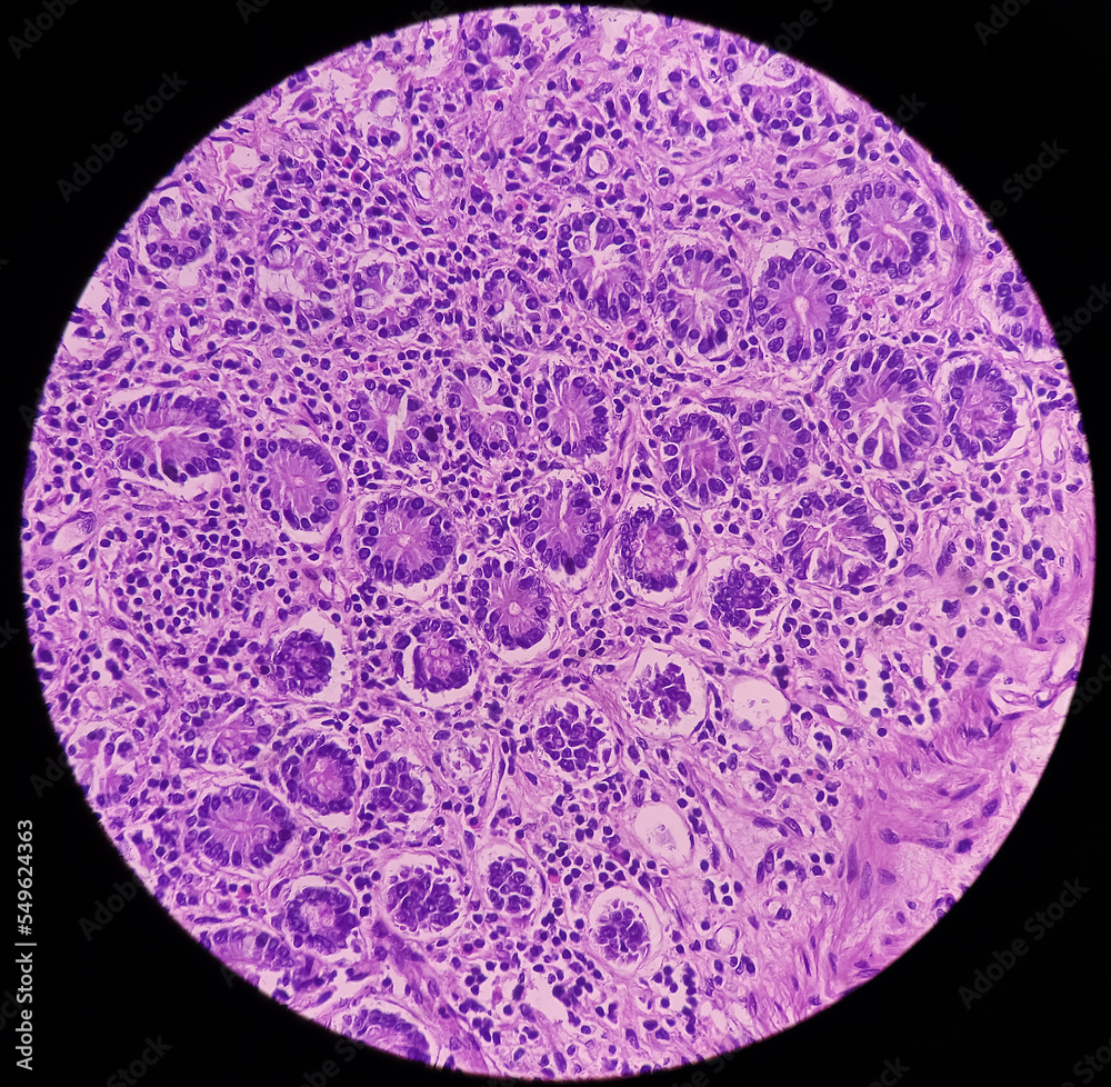 Intra Abdominal Mass With Transverse Colon Biopsy Fibromatosis Nodular Mass Show Spindle