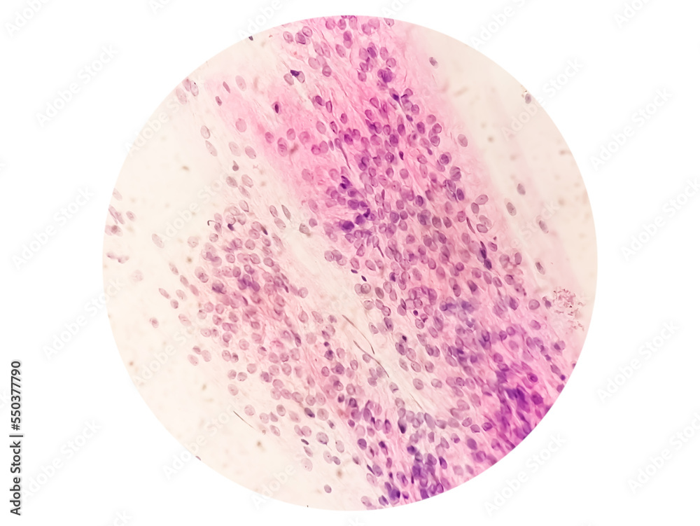 Microscopic view of Trichomonas vaginalis in pap smear with few acute ...