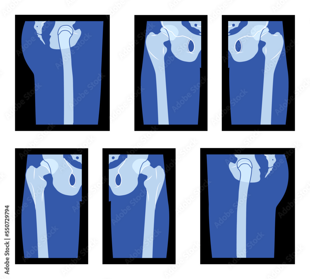 Set of X-Ray Hip and Leg, Head of the femur, Skeleton Human body Bones ...