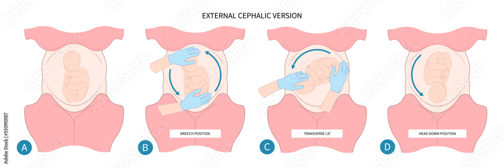 birth defect of Baby Labor C section praevia Mother twins cord hip lie ...