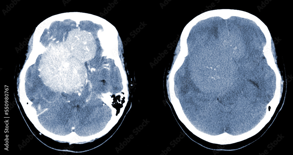 CT Brain Axial scans hyperdense mass with homogeneous, and mild ...