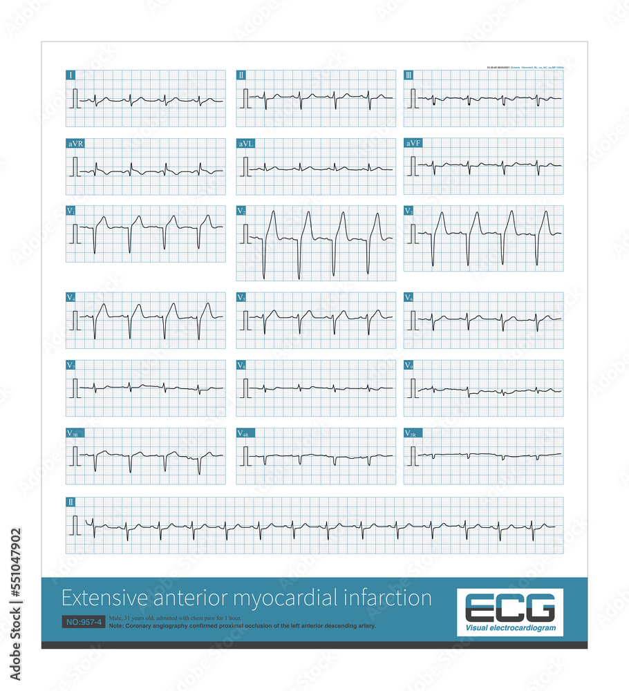 A 31 year old male was clinically diagnosed as extensive anterior ...