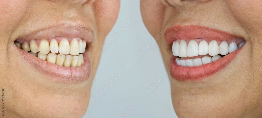 before after shot smile makeover Stock Photo | Adobe Stock