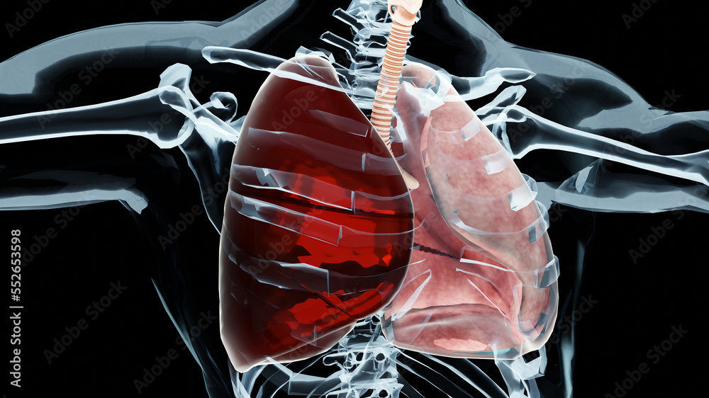 3d Illustration of Hemothorax, Normal lung versus collapsed, symptoms ...