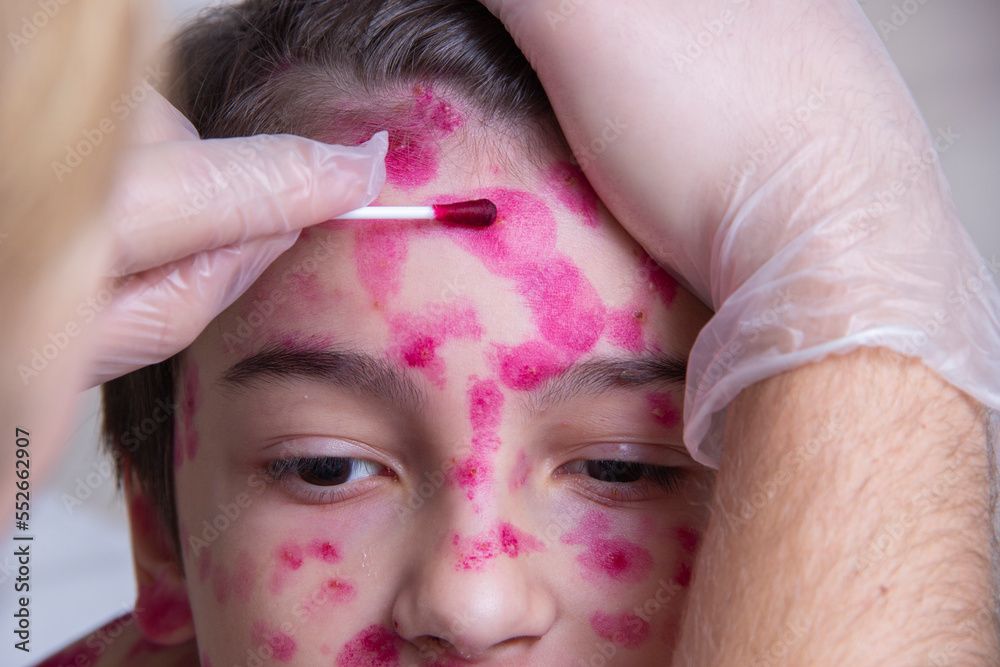 The skin rash in a child is treated with a cotton swab. Chickenpox ...