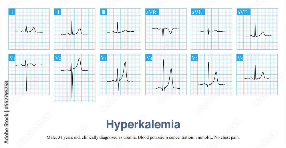 Stockillustrationen High-sharp T waves of hyperkalemia need to be ...