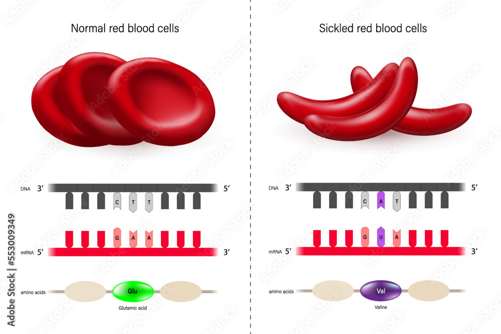 Sickle cell disease. Normal red blood cells and sickled red blood cells. Point mutation. Stock ...