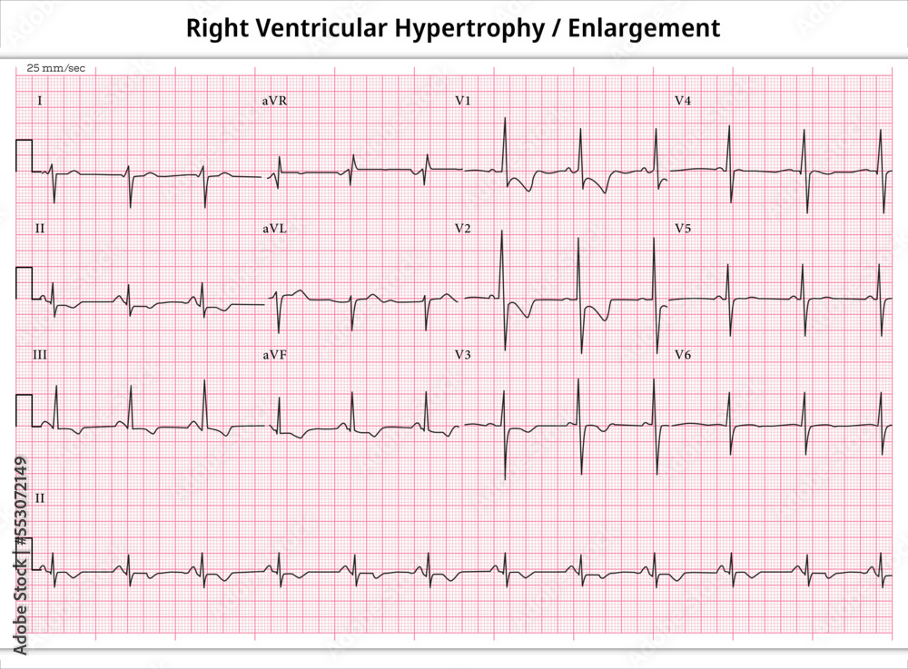 ECG Right Ventricular Enlargement - ECG Paper 12 Leads - Right ...