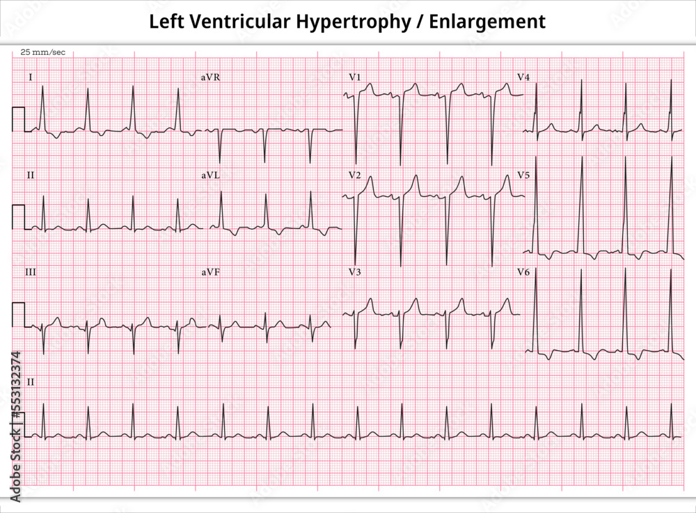 ECG Left Ventricular Enlargement - ECG Paper 12 Leads - Left ...