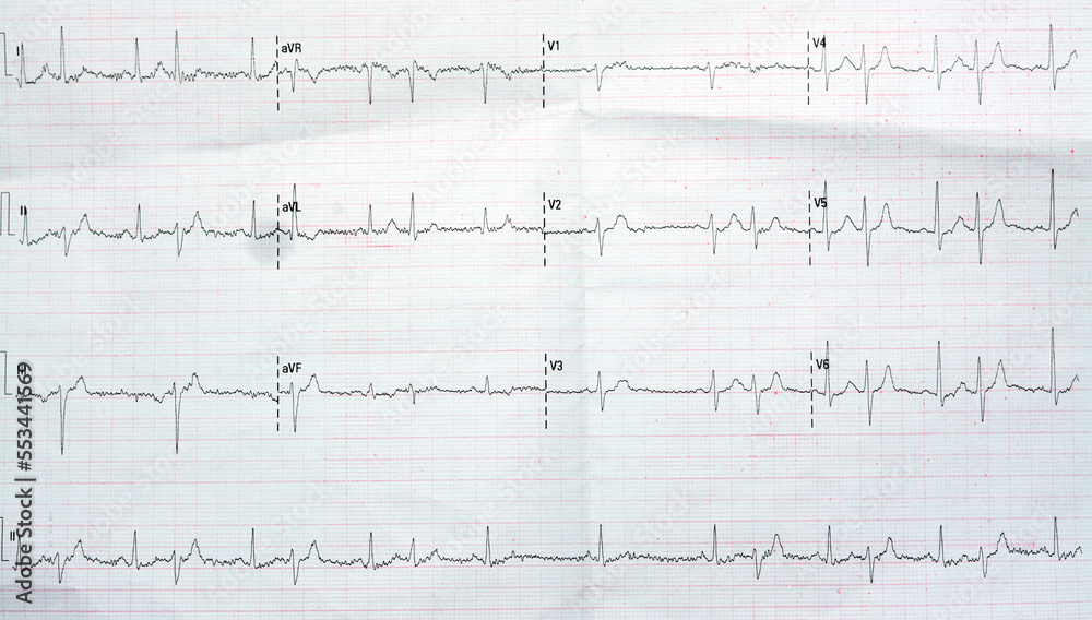 ECG ElectroCardioGraph paper that shows Normal Sinus Rhythm NSR with ...