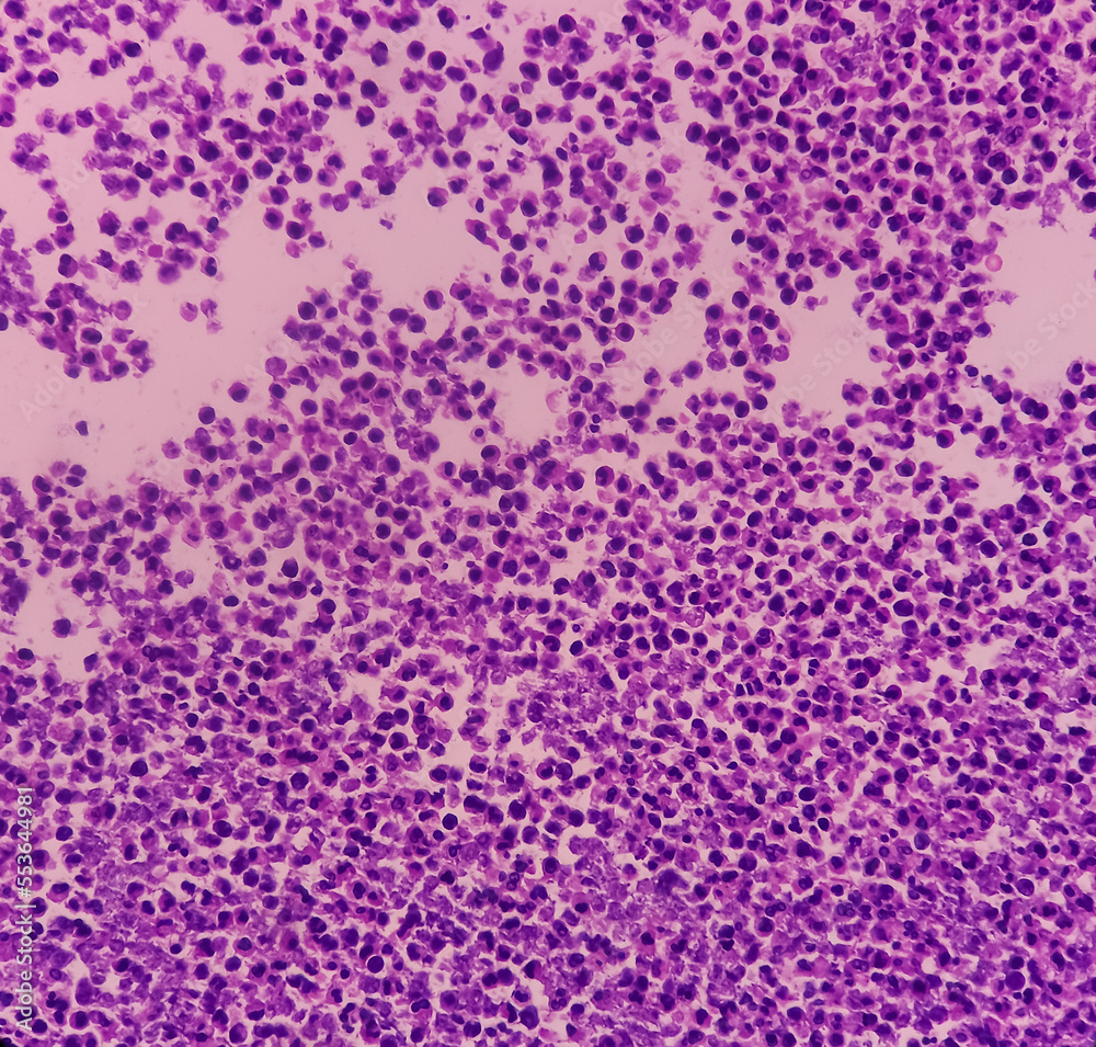 Microscopic view of cheek cyst, Mucous retention cyst, benign ...