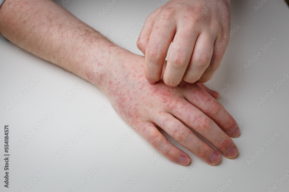 Finger scratching hands with allergic red rash. Derma disease with ...