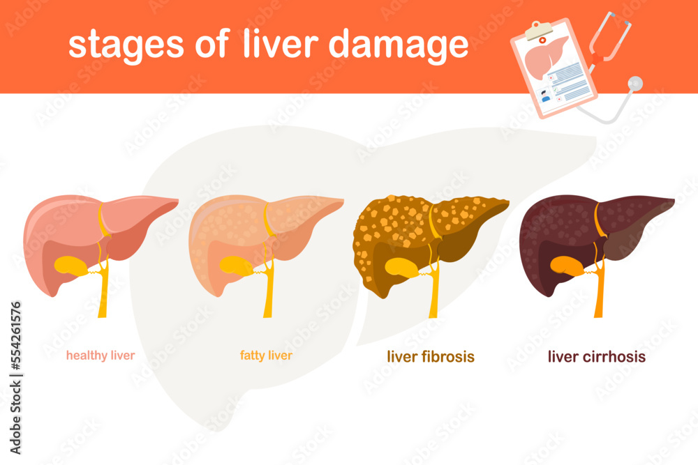 Stage vector illustration of liver damage From Healthy Liver to Fatty ...