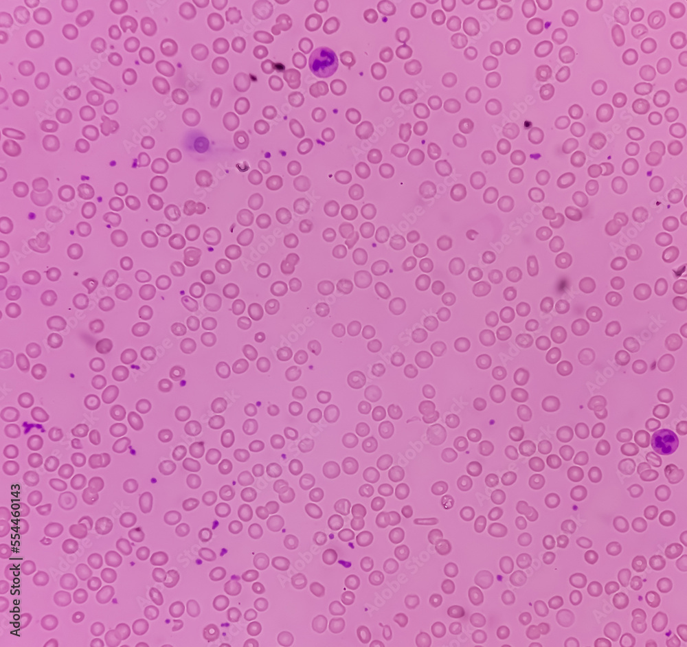 Microscopic view of blood smear, Hereditary hemolytic anemia ...